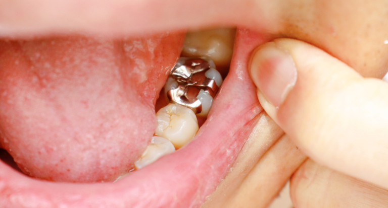 Your Guide to Mercury Fillings: What You Should Know.